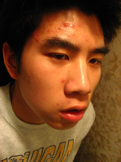 Asian Skin... - General acne discussion - Acne.org