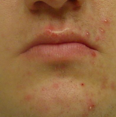 Large, Recurring Pustules (Pics) - General acne discussion - Acne.org