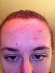 Acne.org - Acne Community & Acne Treatment Store