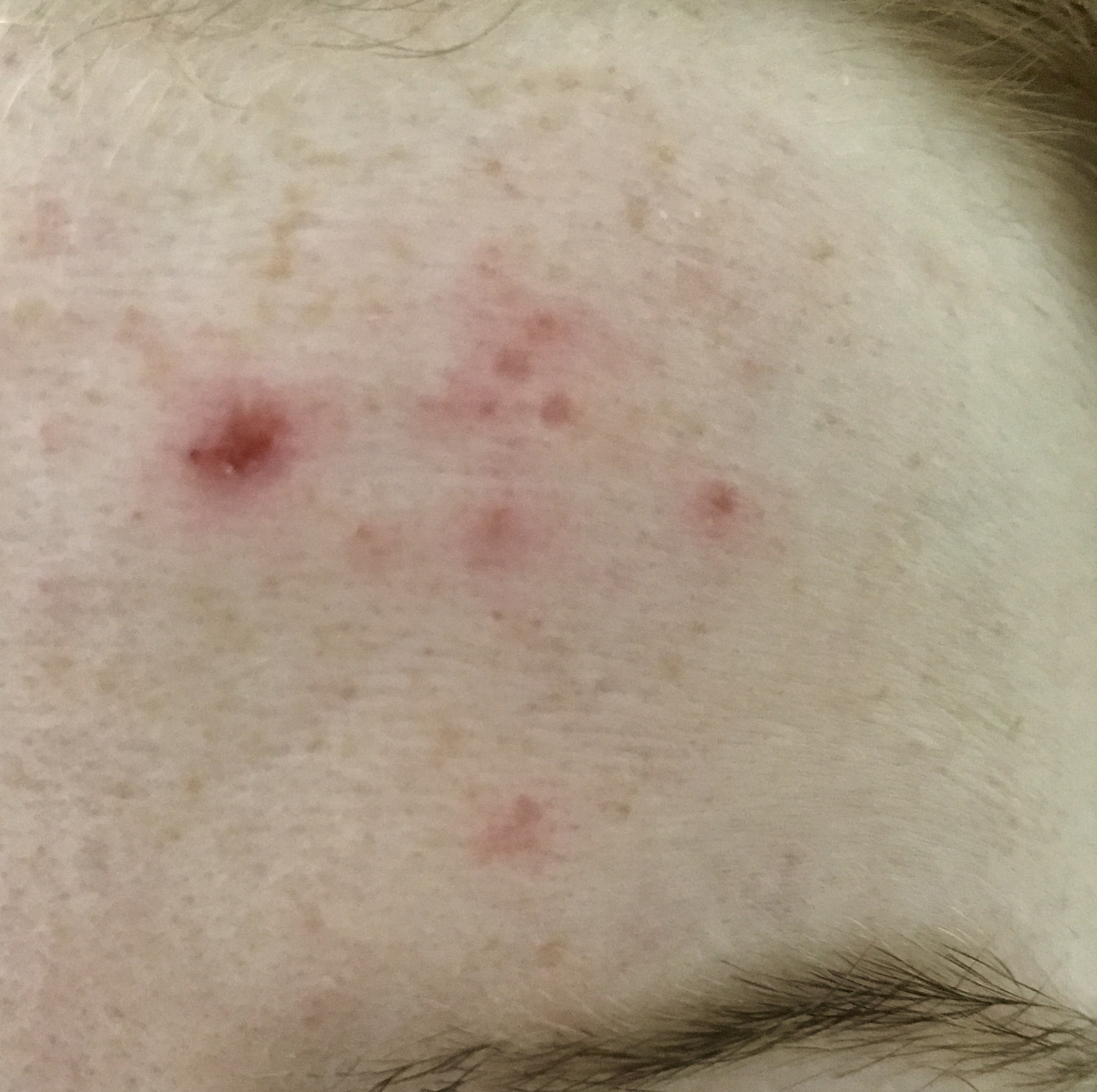 Bed Bug Bites On Forehead