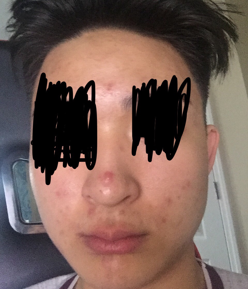 Skin Bump On Nose