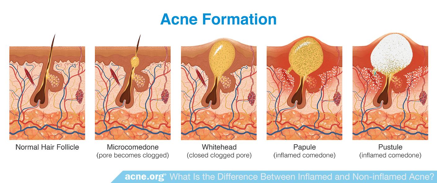 What Is the Difference Between Inflamed and Non-inflamed Acne?