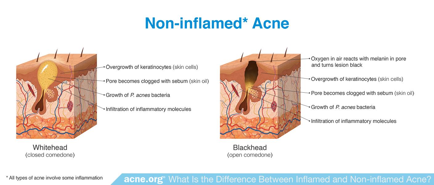 What Is the Difference Between Inflamed and Non-inflamed Acne?