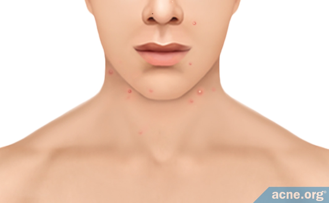 Neck Acne Treatment - Acne.org