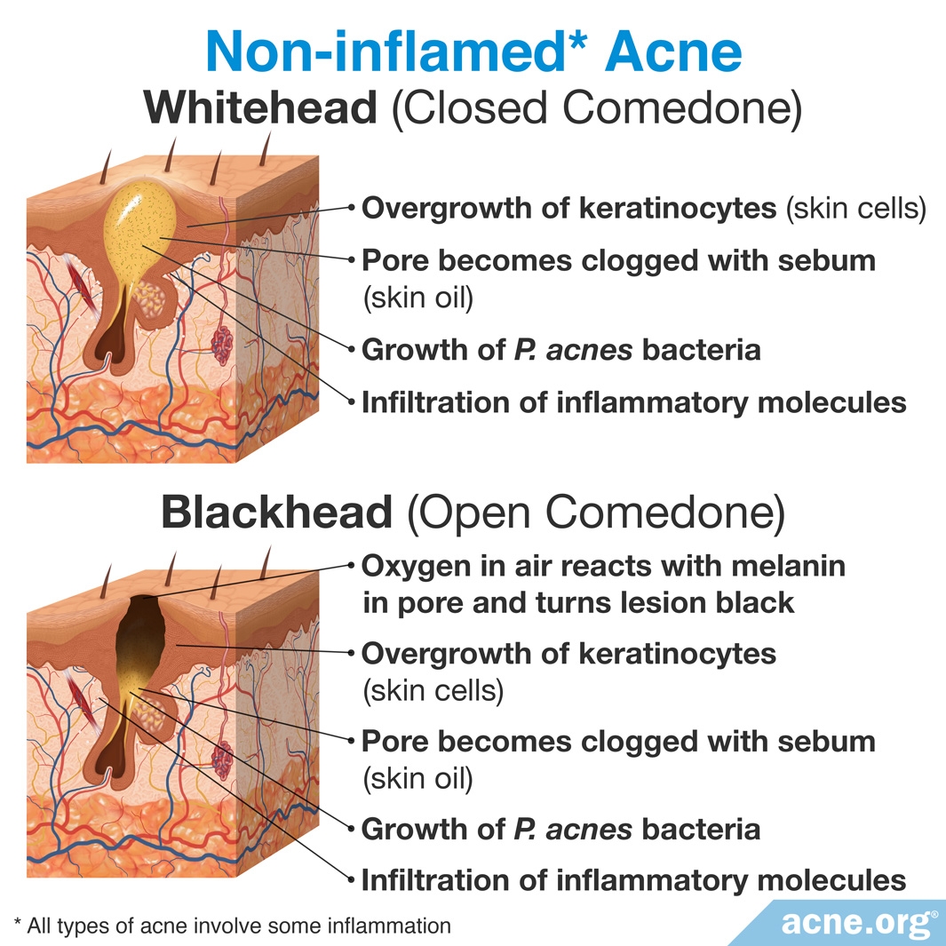 What Is the Difference Between Inflamed and Non-inflamed Acne? - Acne.org