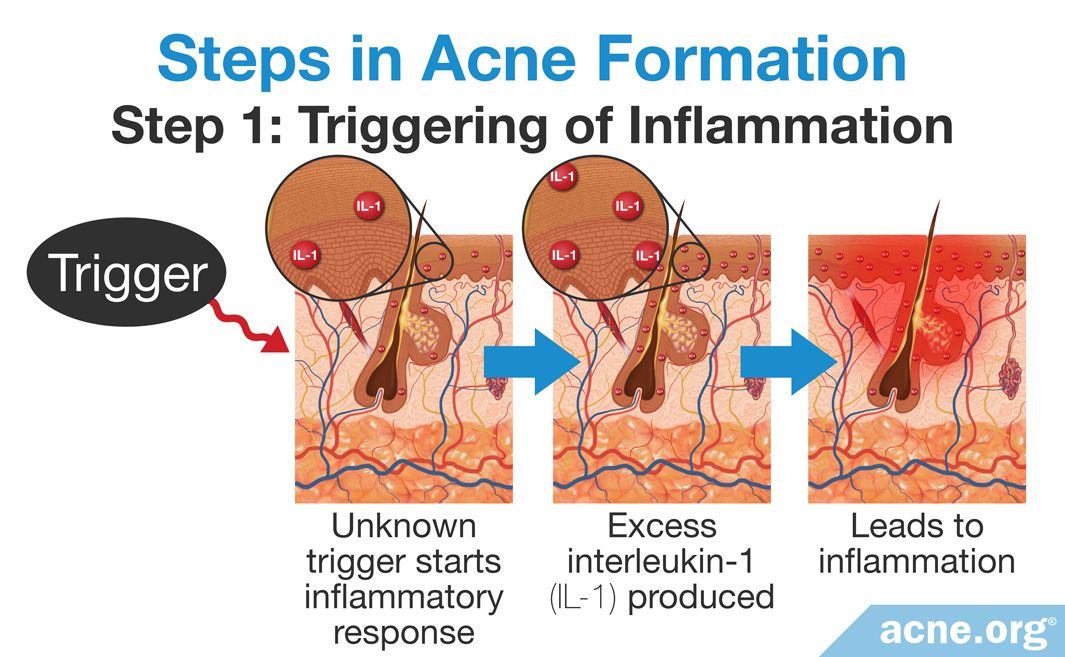 Scientists Now Believe Acne Is Primarily Inflammatory - Acne.org