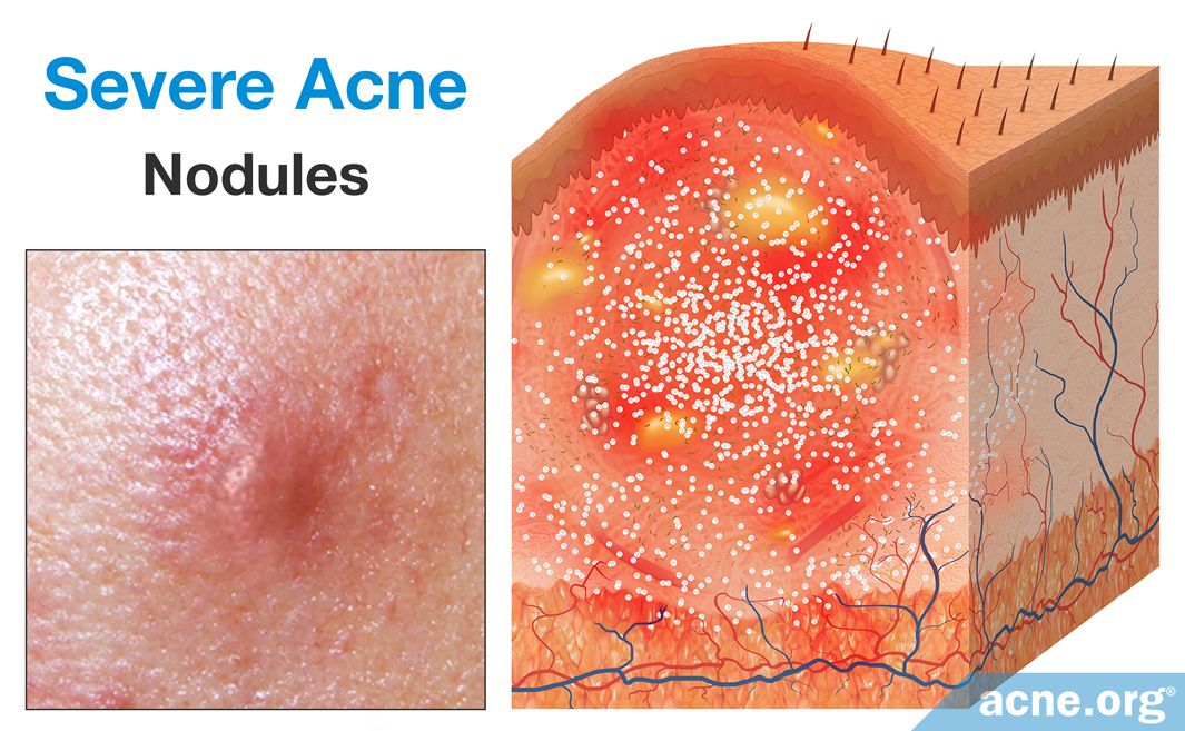 What Is Acne - An In-depth Look - Acne.org
