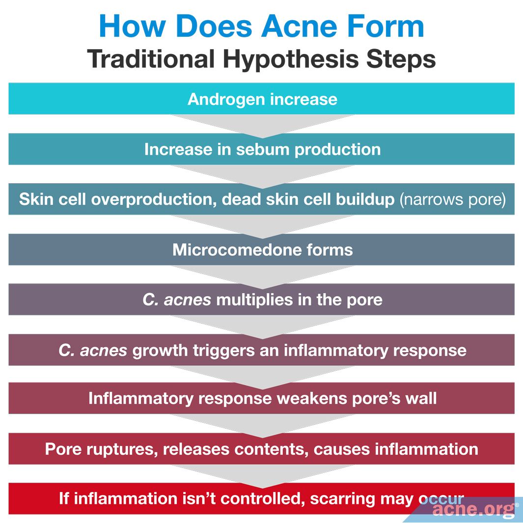 What Is Acne - An In-depth Look - Acne.org