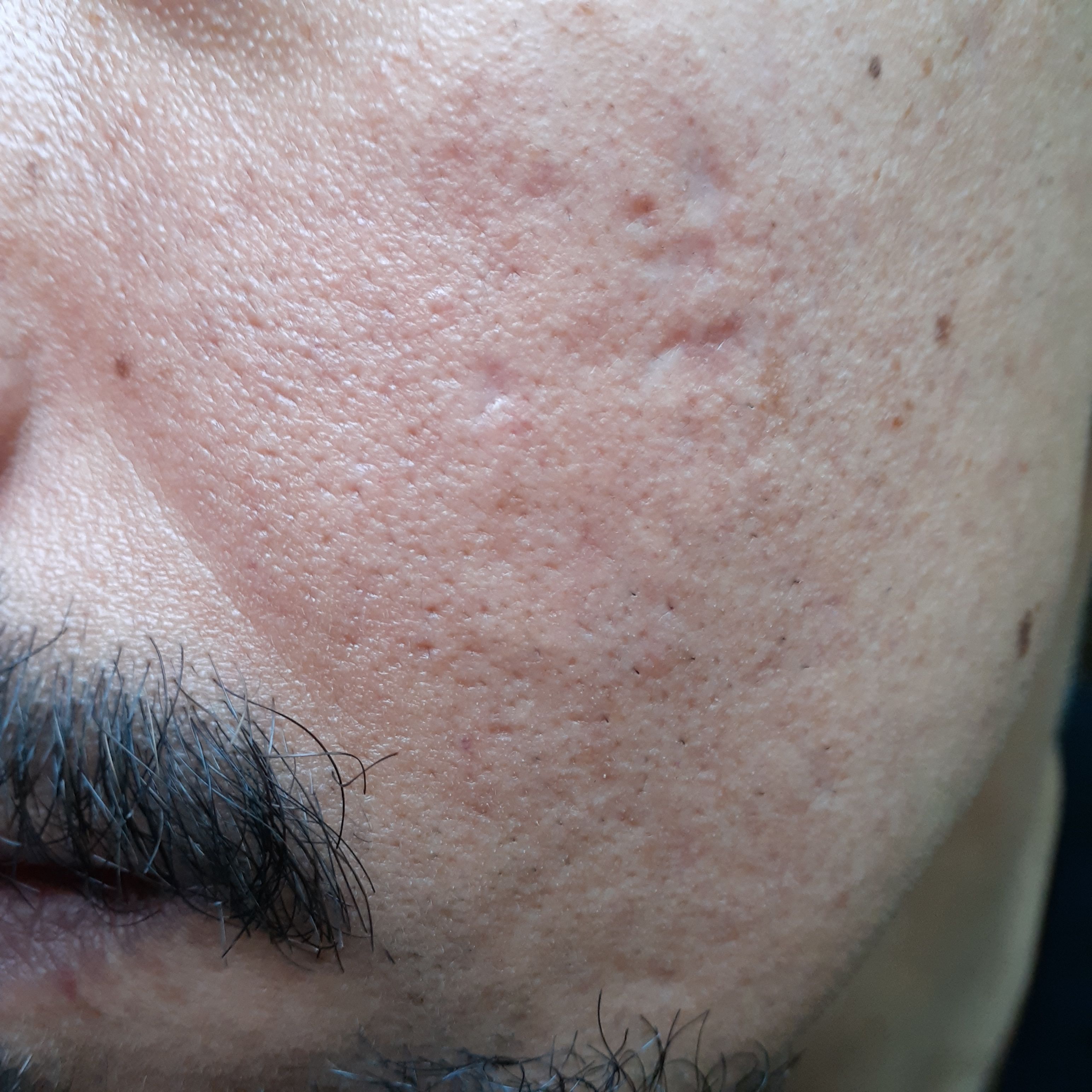 Help! Severe acne scars – Page 2 – Scar treatments – Acne.org Forum