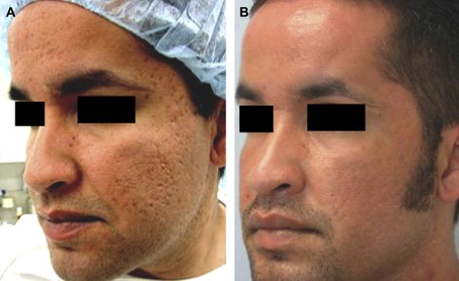 Rullans Phenol Peel Treatment Scar Treatments