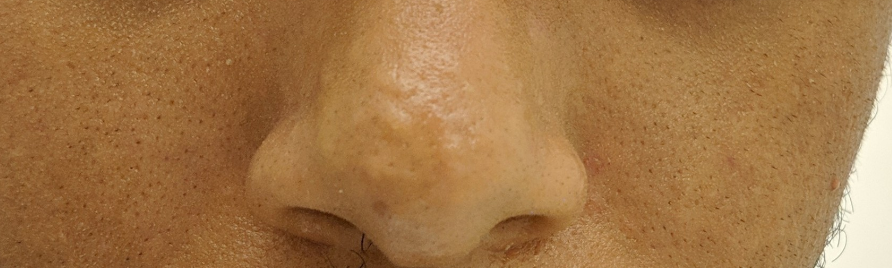 I have bumps on my nose for couple years can someone help me? - Scar ...