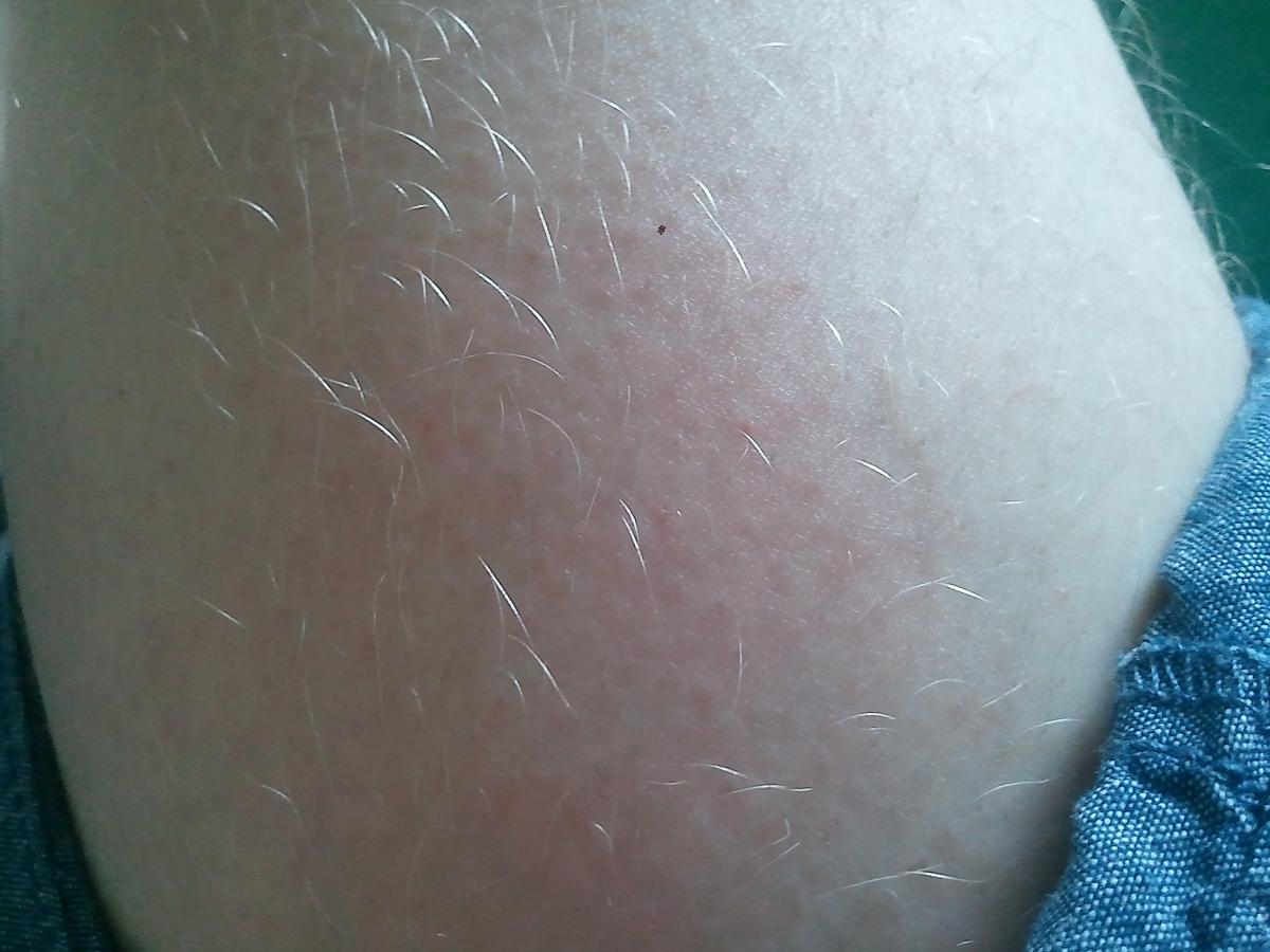 Accutane Rash - Prescription acne medications - Acne.org